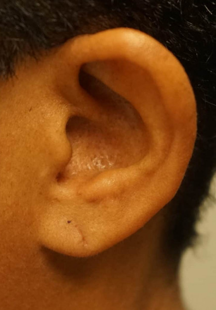 Earlobe Repair - Tara Ramachandra MD