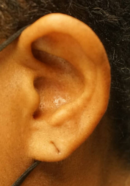 Earlobe Repair - Tara Ramachandra MD
